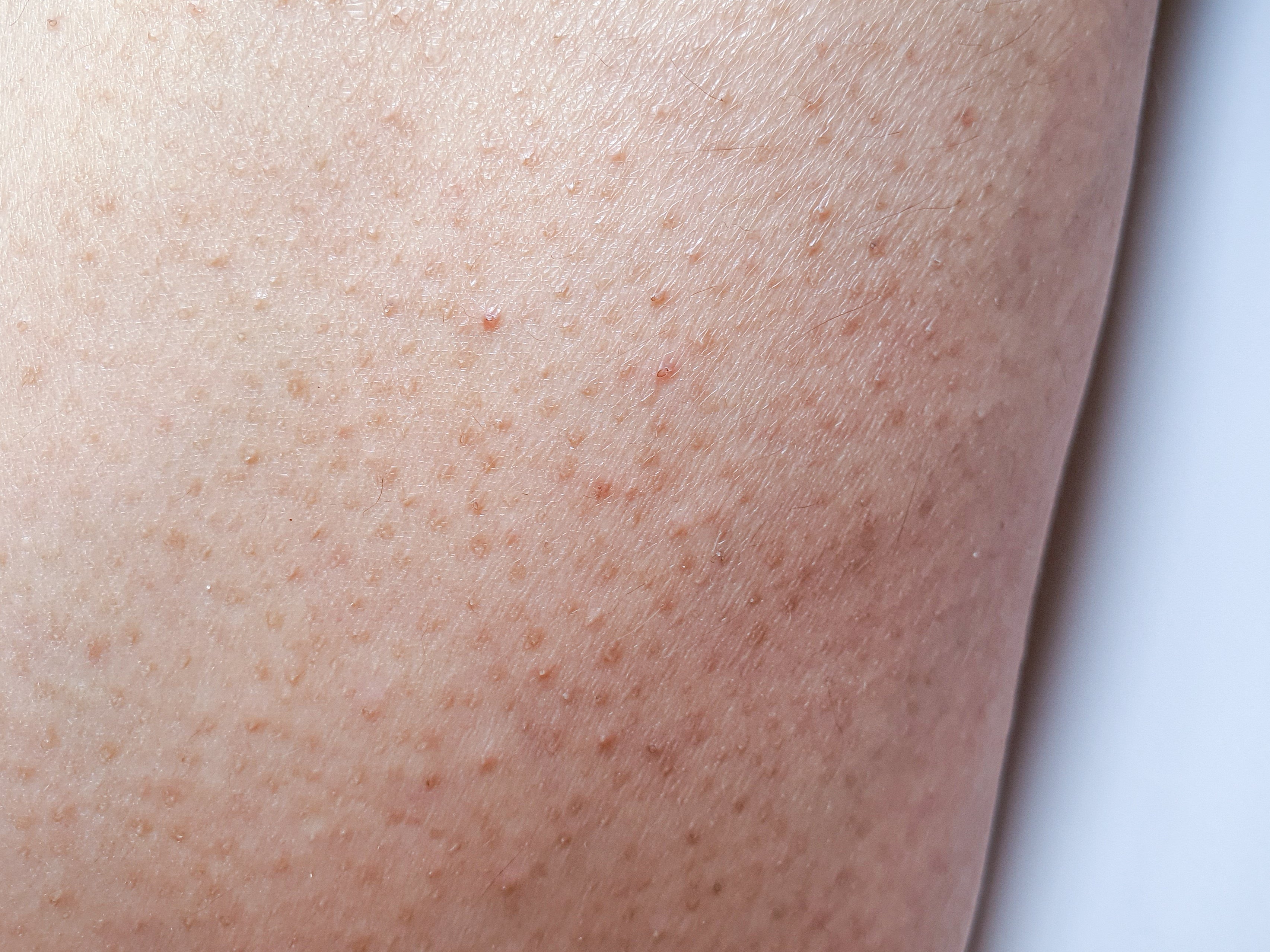 Chicken Skin keratosis Pilaris Causes Treatment And 41 OFF Chicken Skin keratosis Pilaris Causes Treatment And 41 OFF